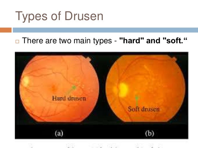 Drusen