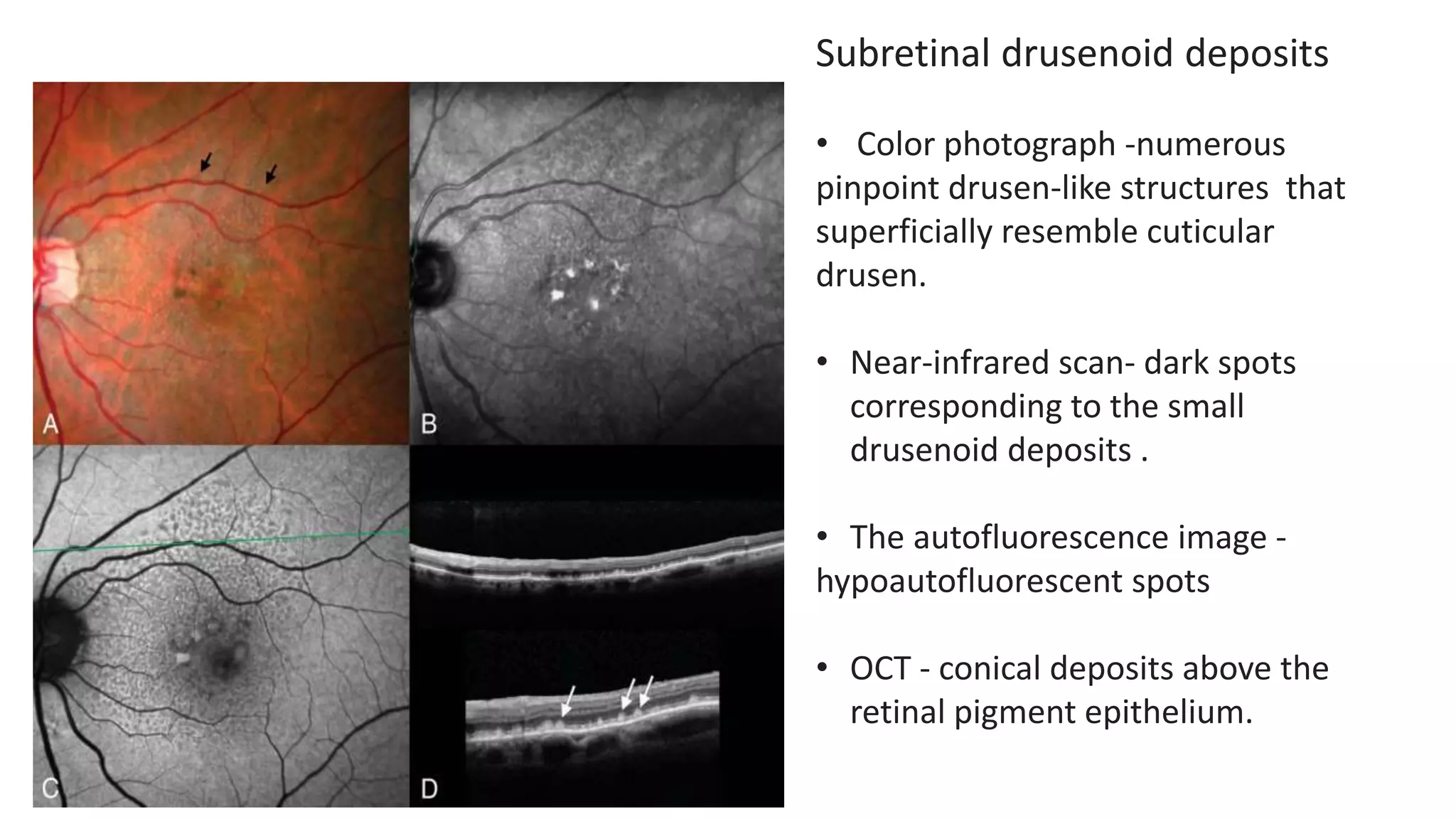 Drusen characterization | PPTX