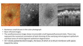 Drusen characterization | PPTX