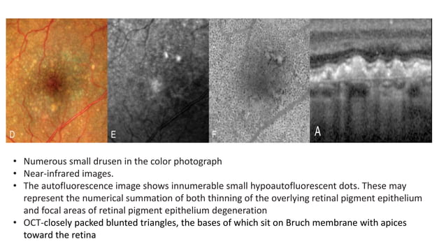 Drusen characterization | PPTX