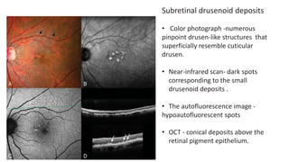 Drusen characterization | PPTX