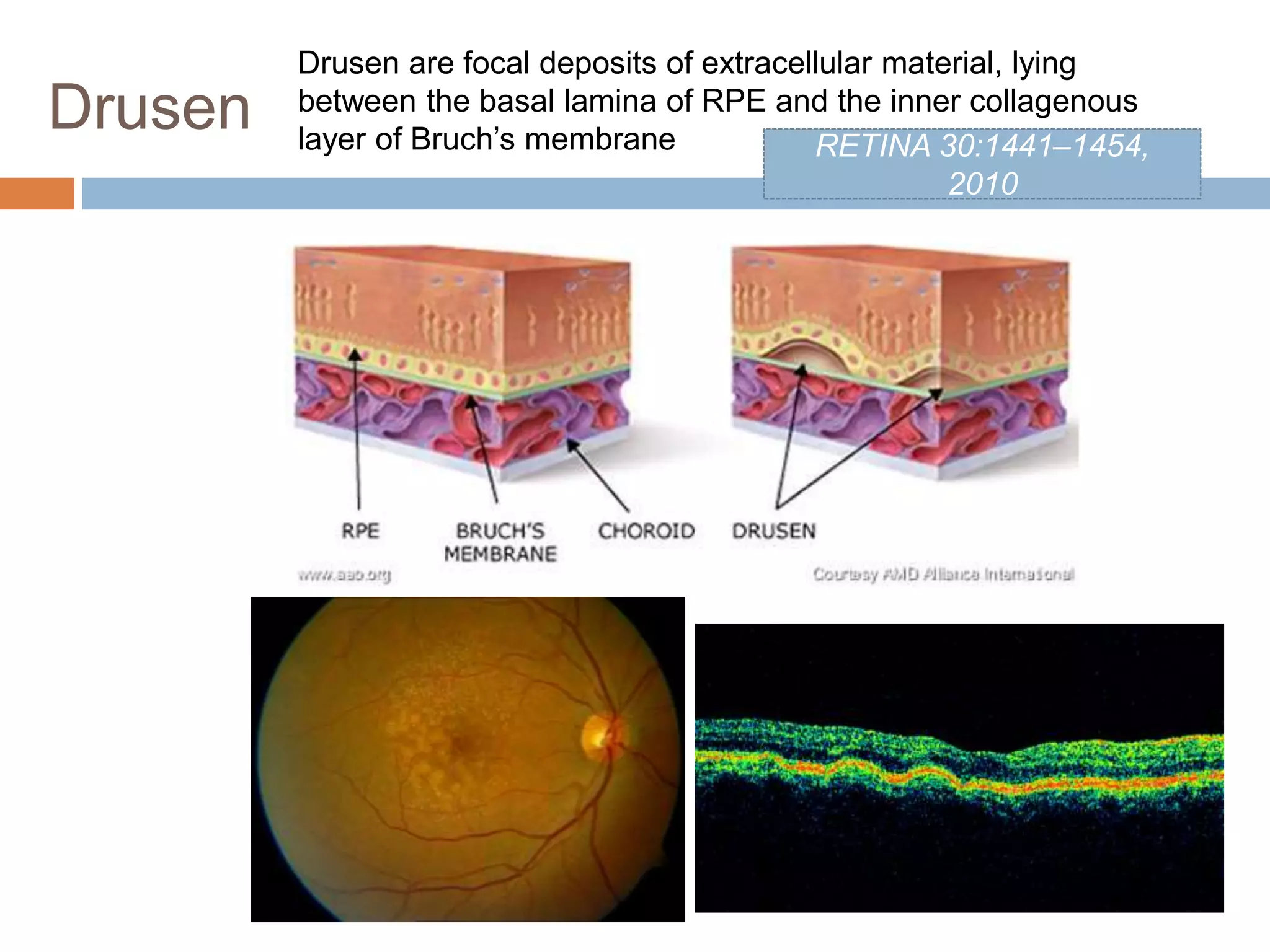 Characteristics of Drusens | PPT