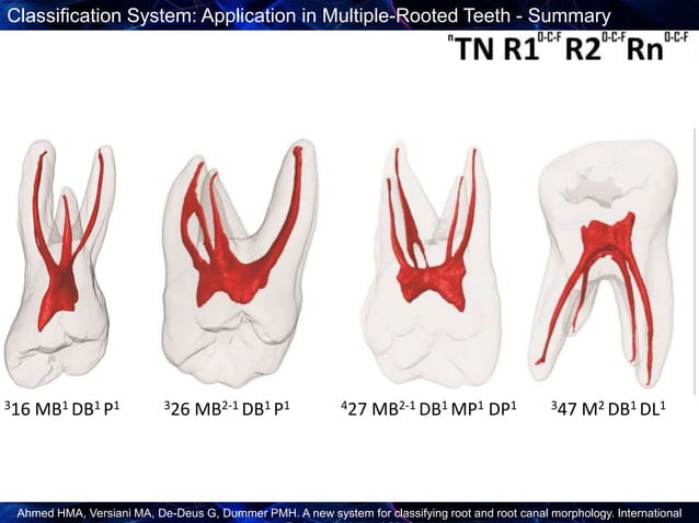 New Root Canal Classification System | PPTX