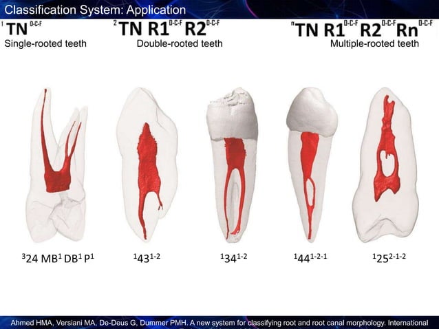 New Root Canal Classification System | PPTX