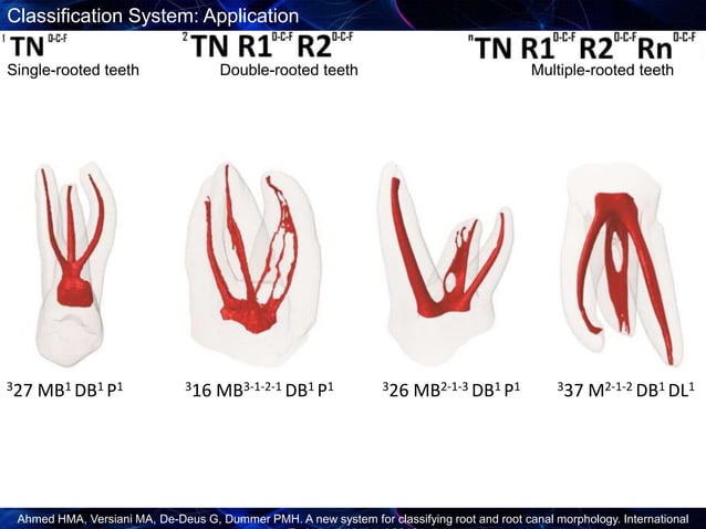 New Root Canal Classification System | PPTX