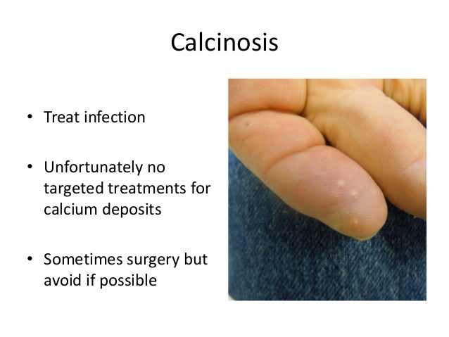 Calcium Buildup On Finger