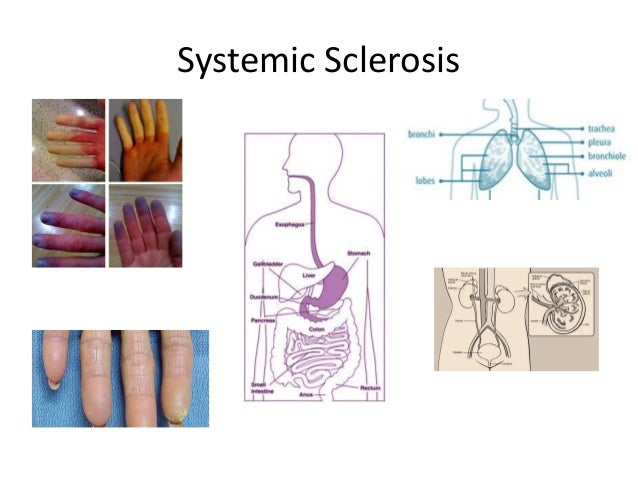 Systemic Sclerosis