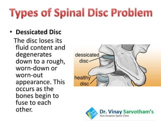 Have a healthy spine by dr vinay sarvotham | PPT