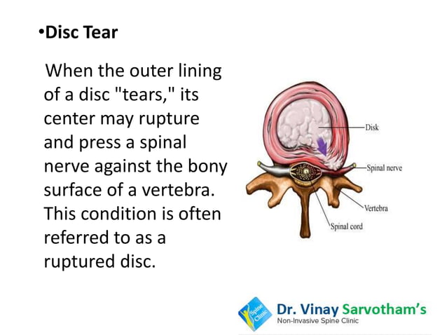 Have a healthy spine by dr vinay sarvotham | PPT