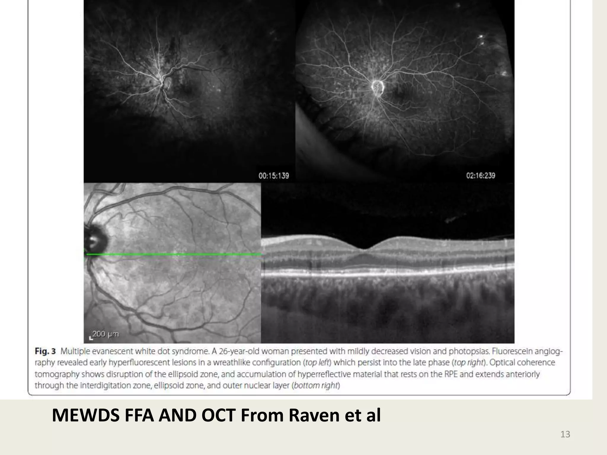 DR WANI'S TALK ON WHITE DOT SYNDROMES.pptx