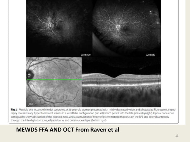 DR WANI'S TALK ON WHITE DOT SYNDROMES.pptx | Eye and Vision Conditions ...
