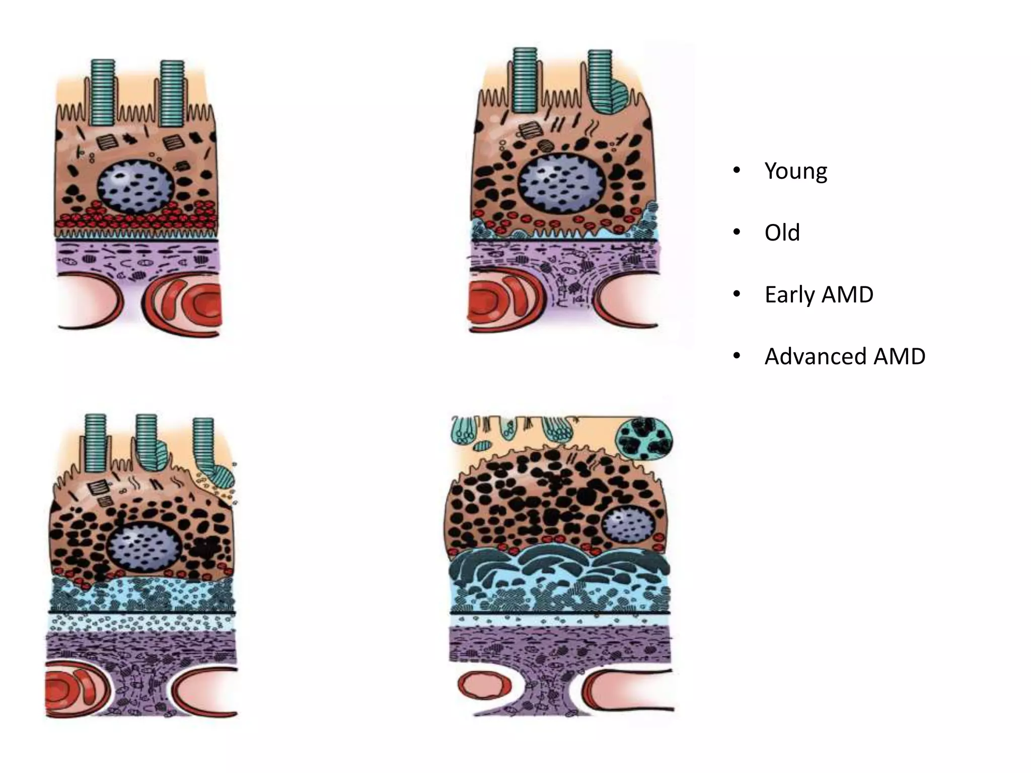 DRY AGE RELATED MACULAR DEGENERATION | PPTX