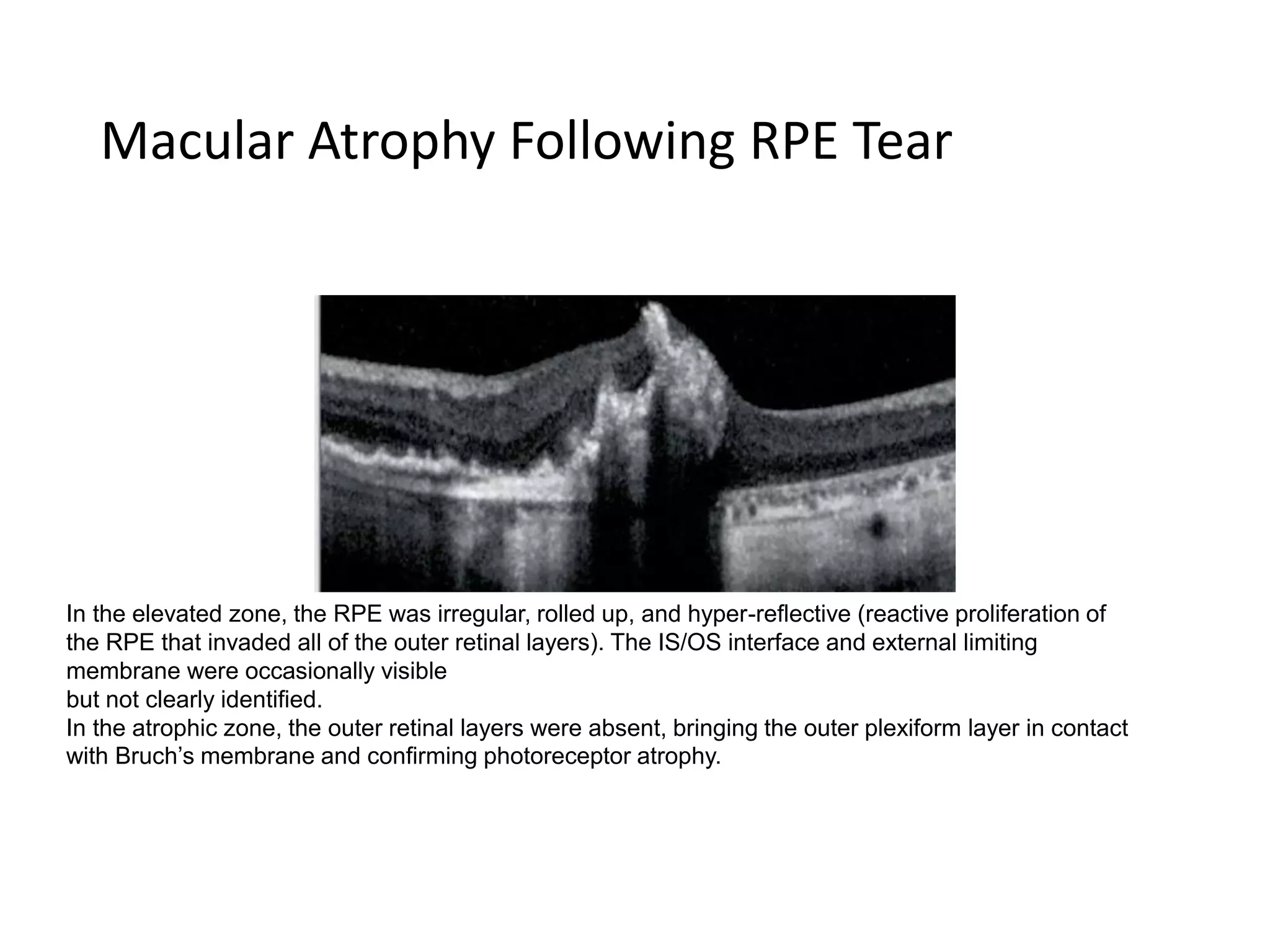 DRY AGE RELATED MACULAR DEGENERATION | PPTX