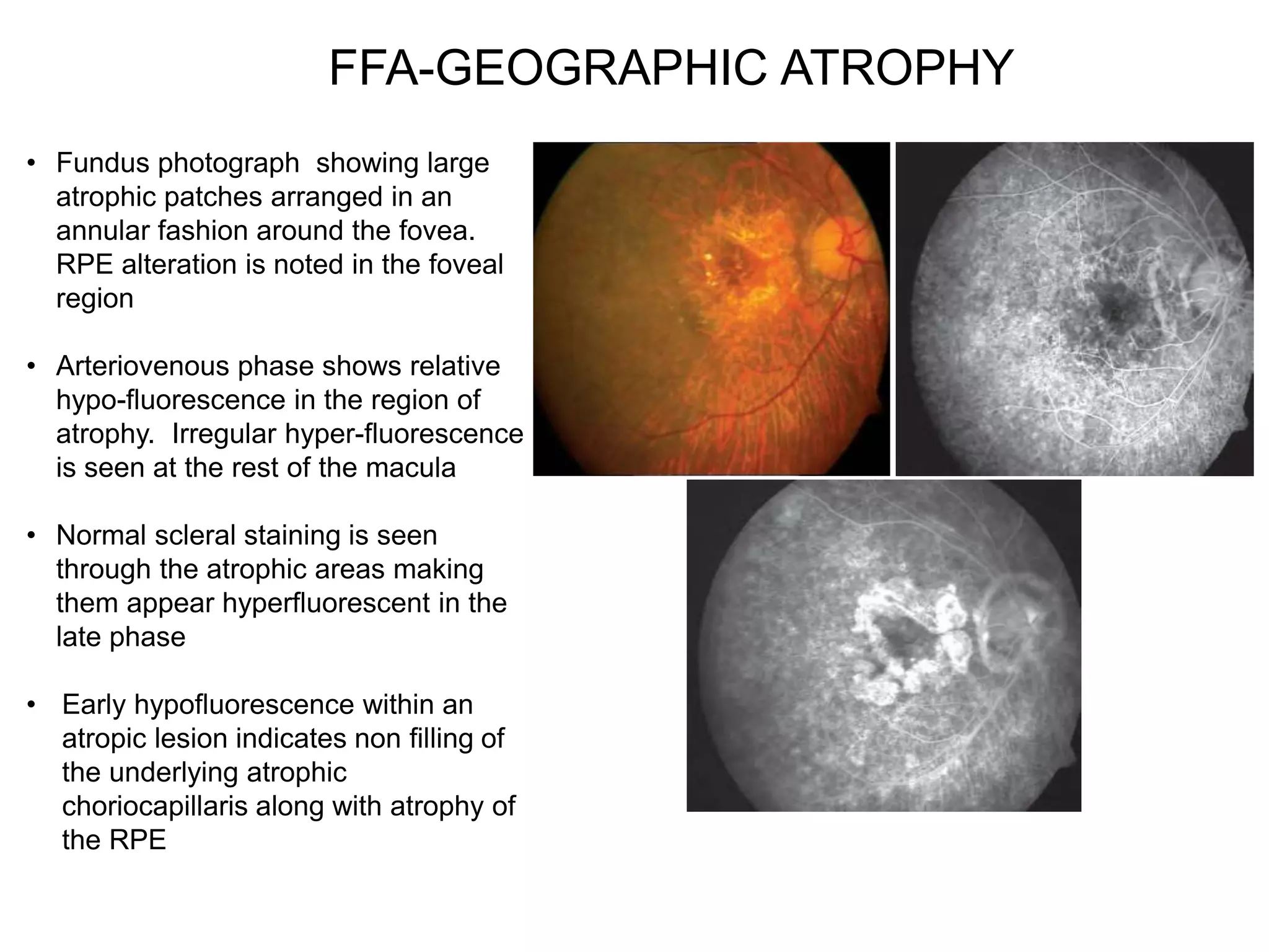 DRY AGE RELATED MACULAR DEGENERATION | PPTX