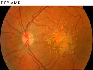 DRY AGE RELATED MACULAR DEGENERATION | PPTX