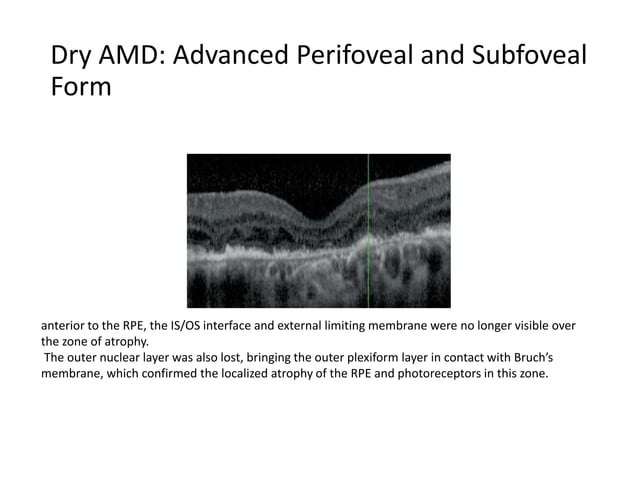 DRY AGE RELATED MACULAR DEGENERATION | PPTX