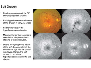 DRY AGE RELATED MACULAR DEGENERATION | PPTX
