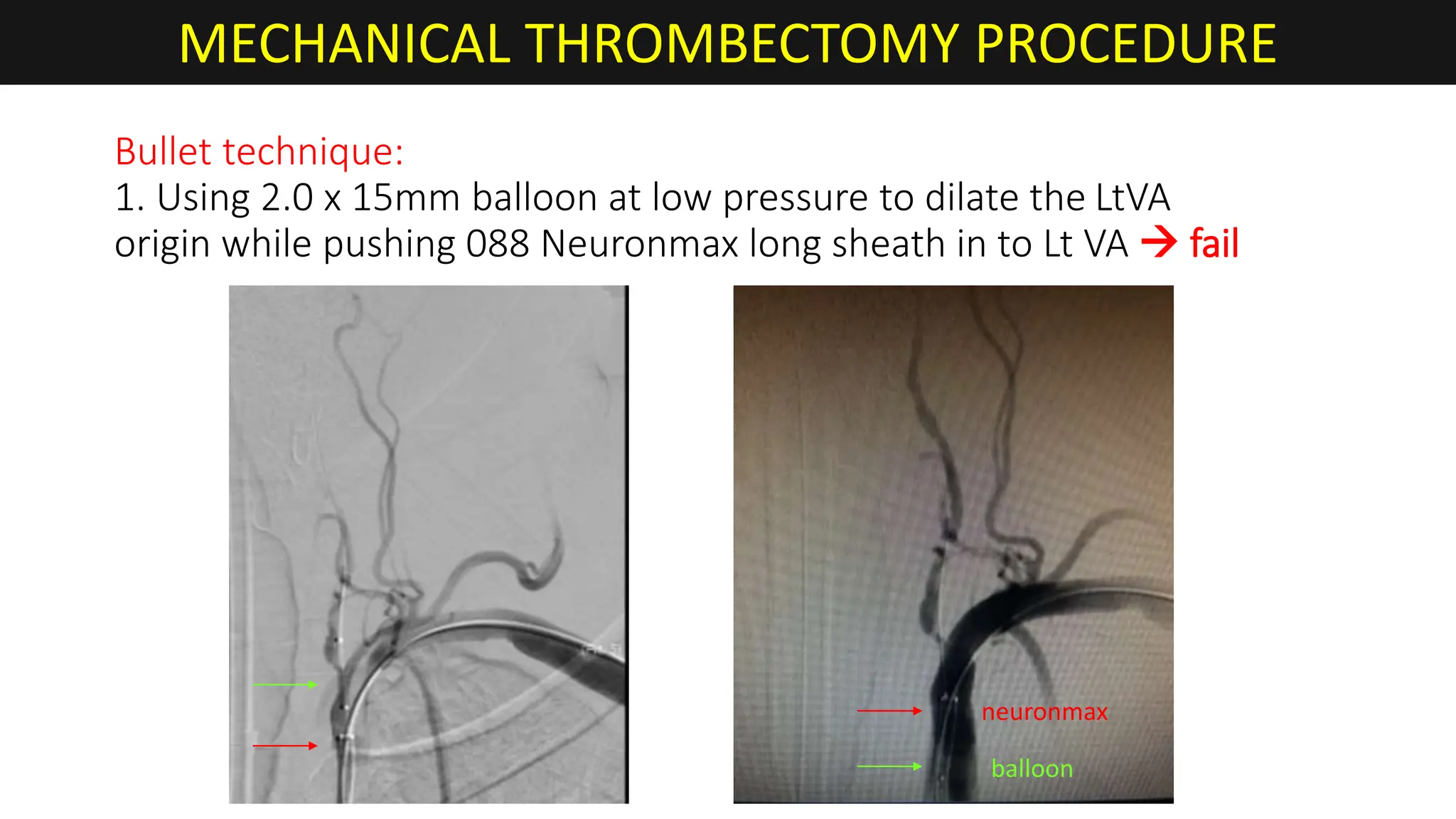 tandem occlusion of VERTEBRAL BASILAR ARTERY OCCLUSION | PPTX