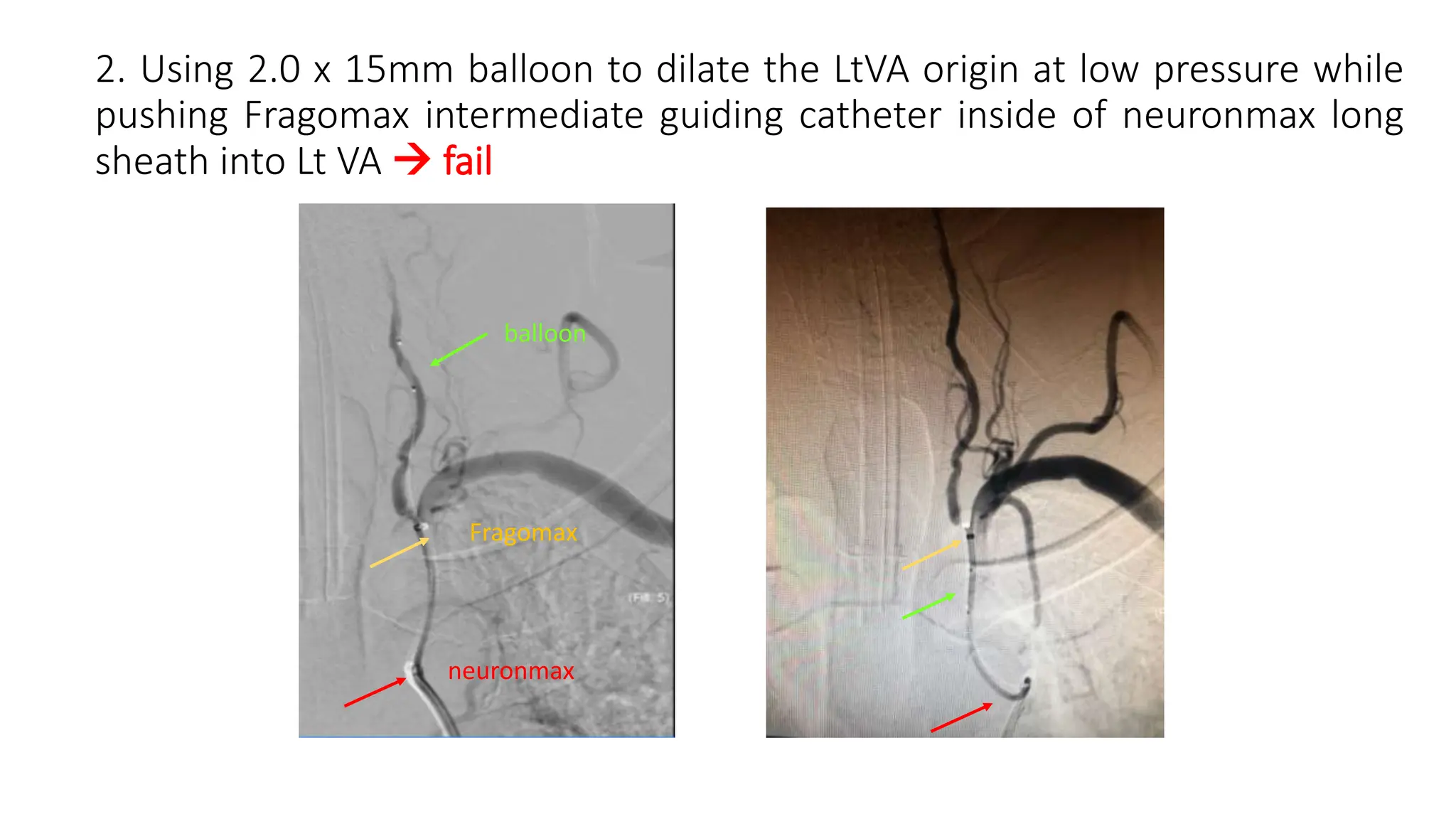 tandem occlusion of VERTEBRAL BASILAR ARTERY OCCLUSION | PPTX