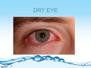 Dry eye | PPT