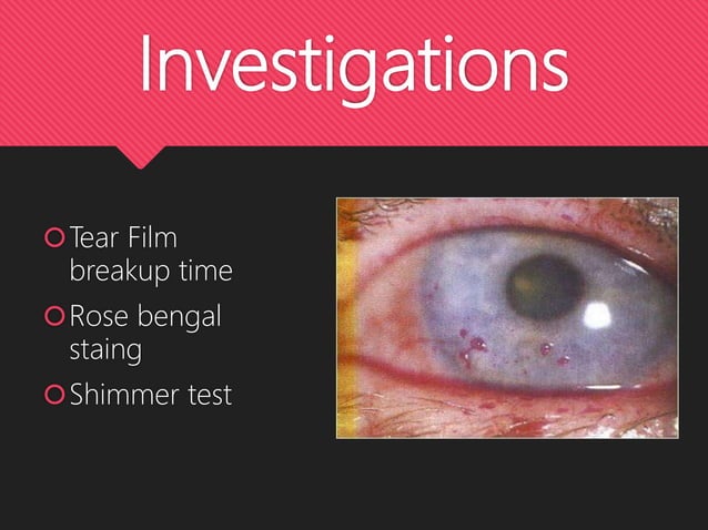 Dry eye | PPT