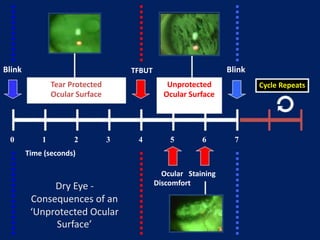 Dry eye | PPTX