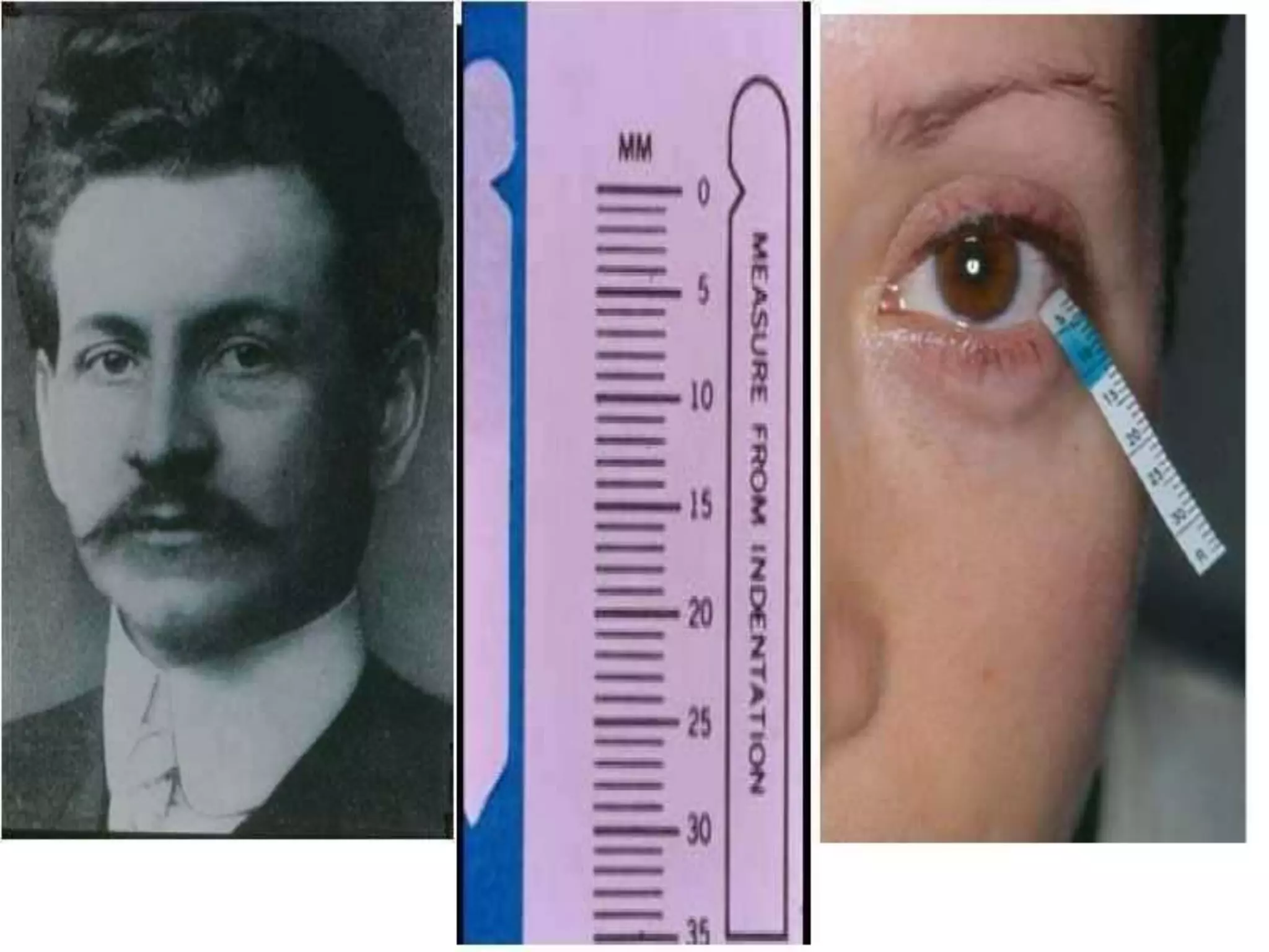 Dry eye sameer | PPT