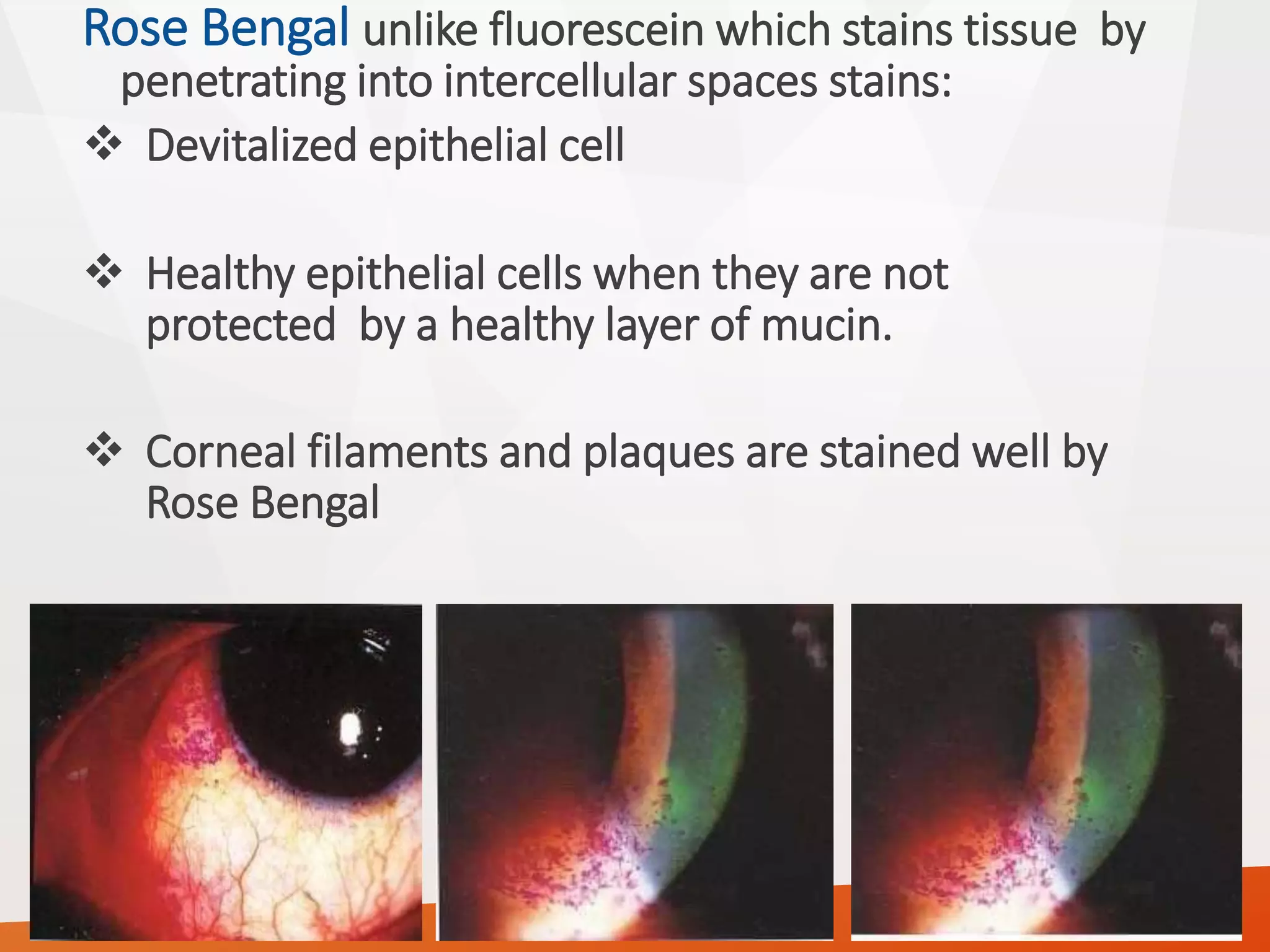 Dry eye sameer | PPT