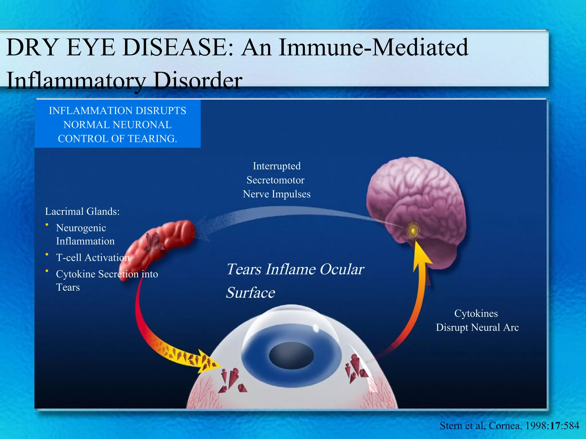 Dry eye | PPT