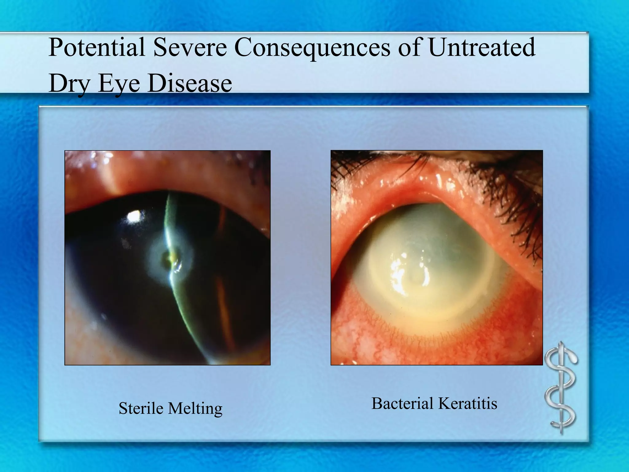Dry eye | PPT