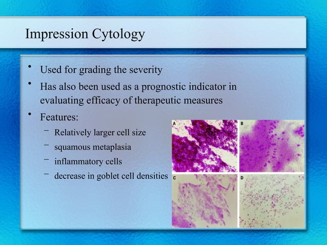 Dry eye | PPT | Eye and Vision Conditions | Diseases and Conditions