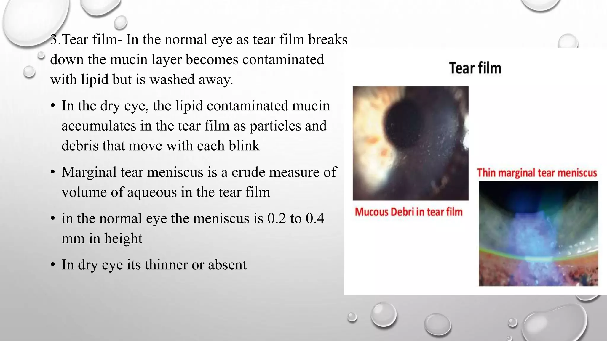 Dry eye disease | PPTX