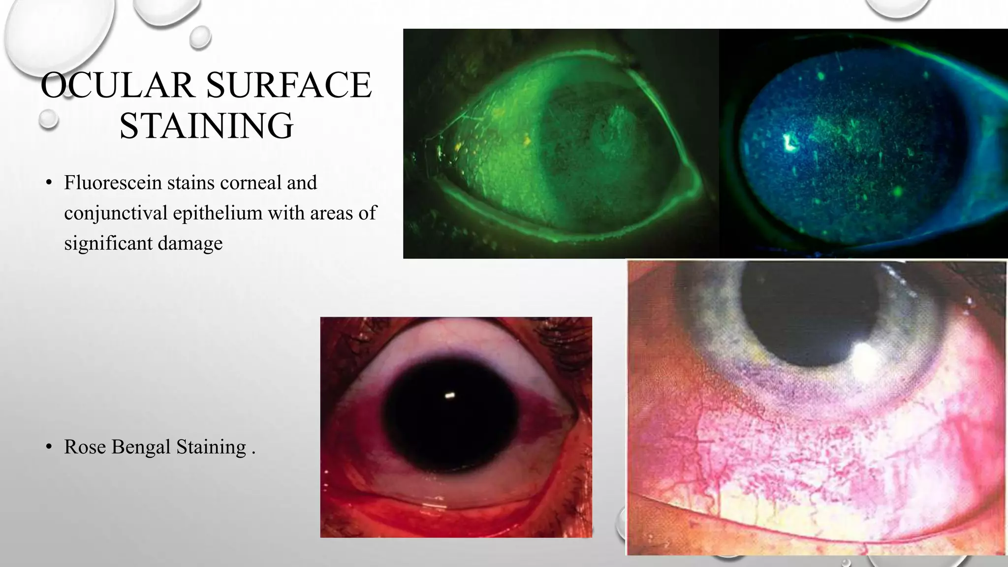 Dry eye disease | PPTX