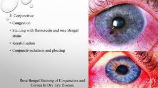 Dry eye disease | PPTX
