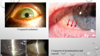 Dry eye disease | PPTX