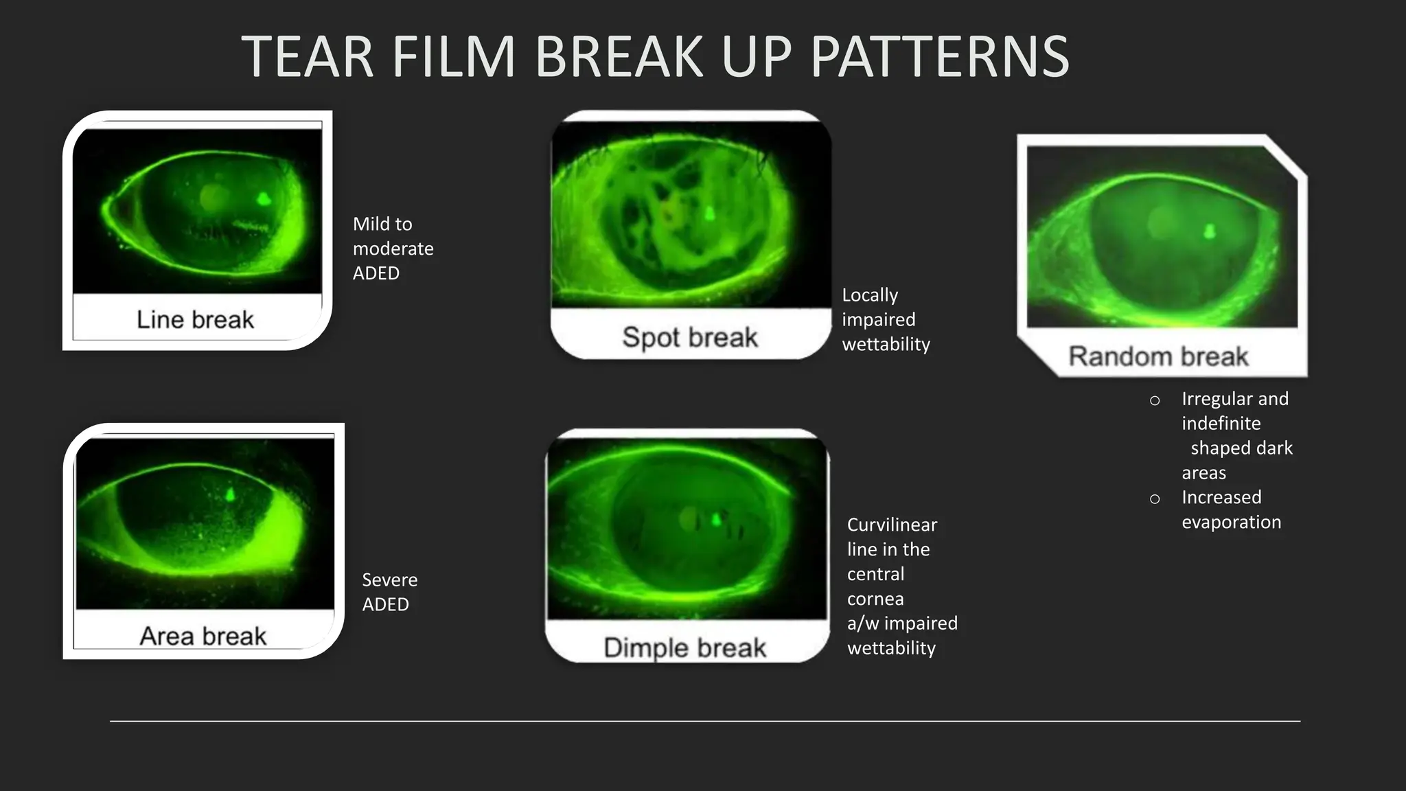 Dry eye disease- Etiology , Classification, Pathology, Staging ...