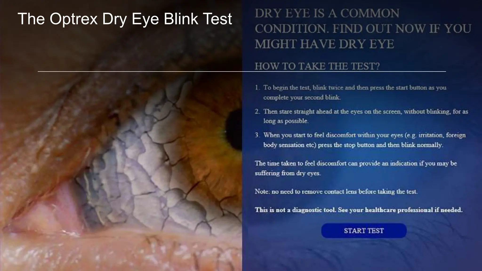 Dry eye disease- Etiology , Classification, Pathology, Staging ...