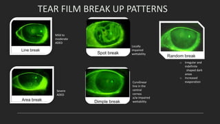 Dry eye disease- Etiology , Classification, Pathology, Staging ...