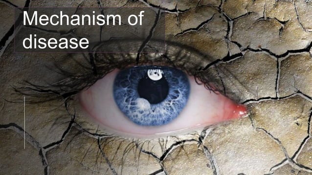 Dry eye disease- Etiology , Classification, Pathology, Staging ...