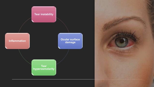 Dry eye disease- Etiology , Classification, Pathology, Staging ...