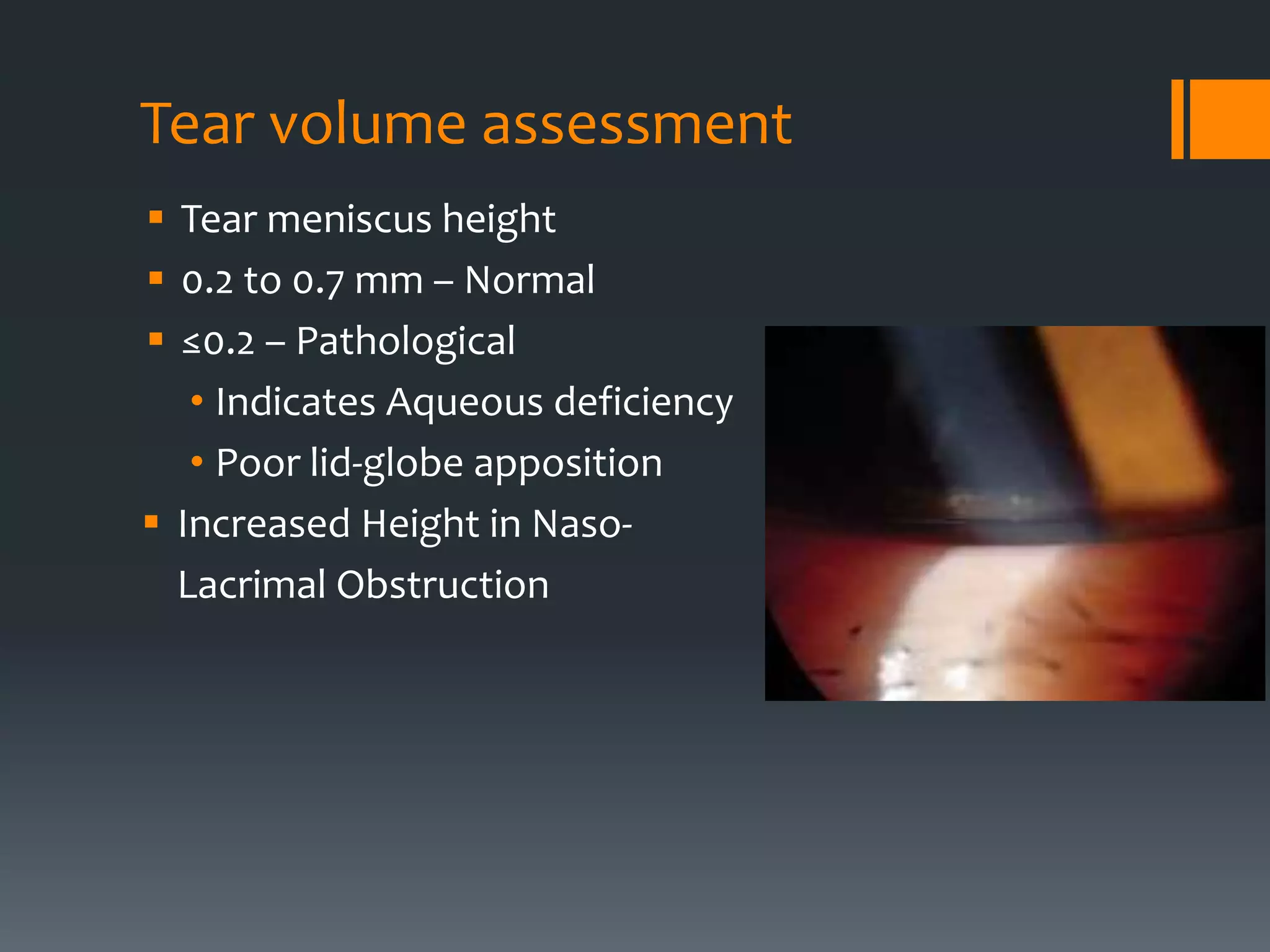 Dry eye evaluation and mx ppt | PPTX