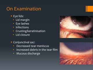 Dry eye evaluation and mx ppt | PPTX
