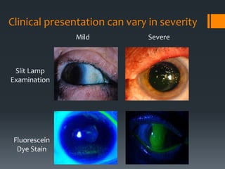 Dry eye evaluation and mx ppt | PPTX