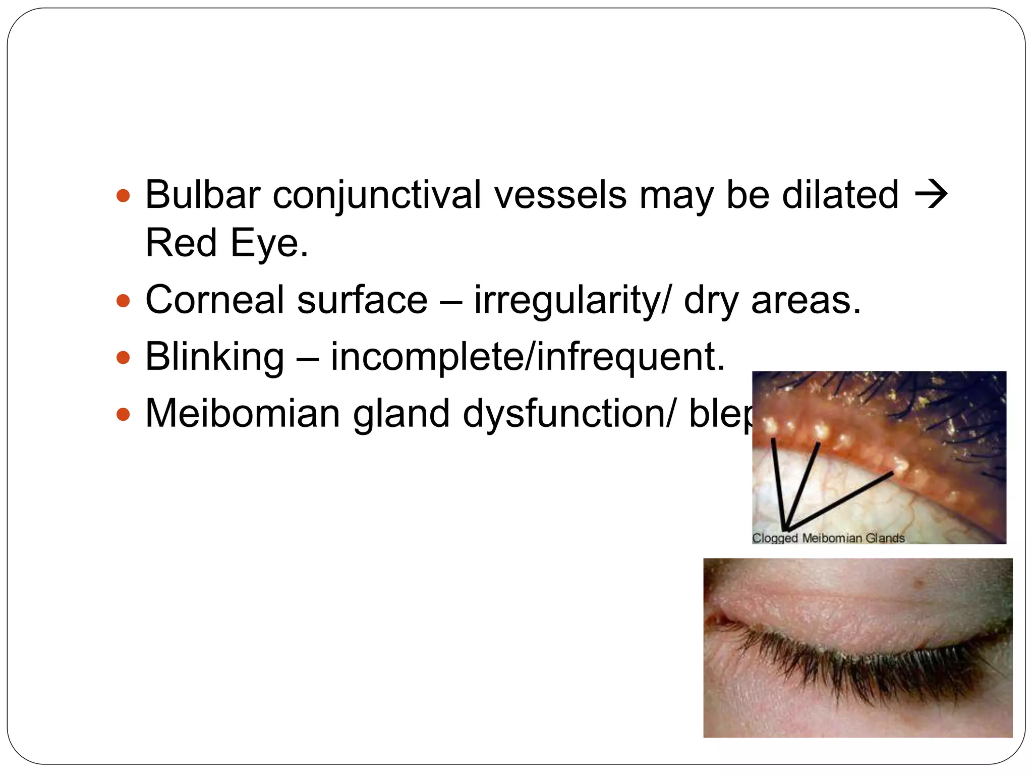 Dry Eye Disease | PPTX