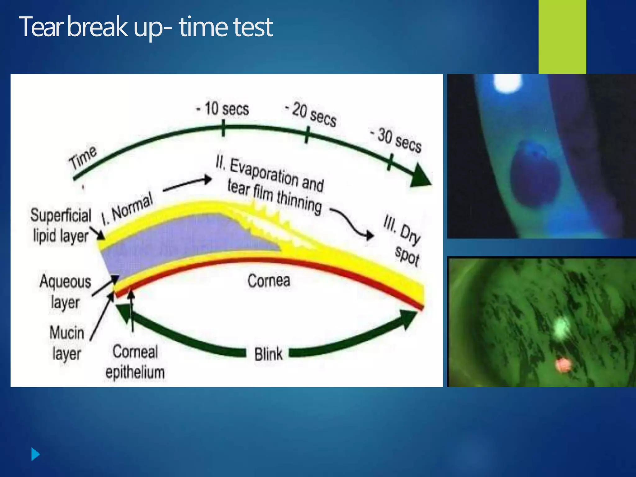 Dry eye diagnosis and management | PPTX