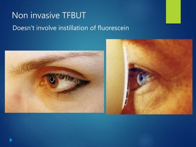 Dry eye diagnosis and management | PPTX