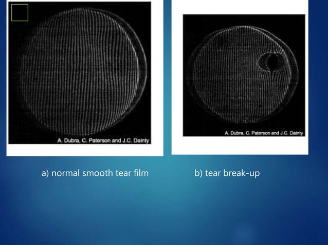 Dry eye diagnosis and management | PPTX