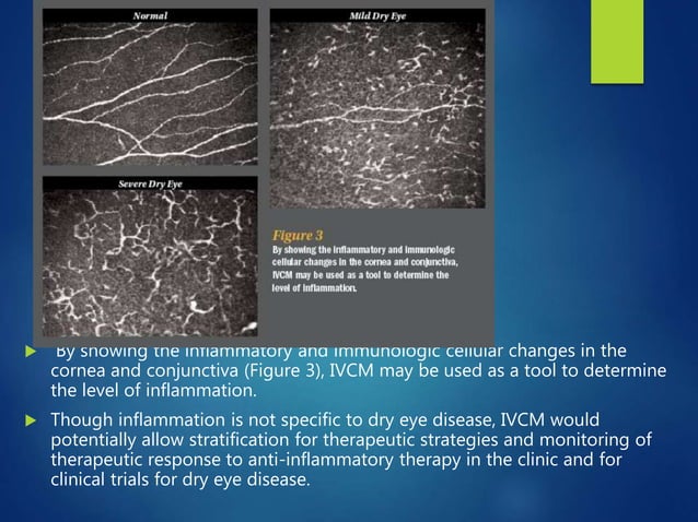 Dry eye diagnosis and management | PPTX