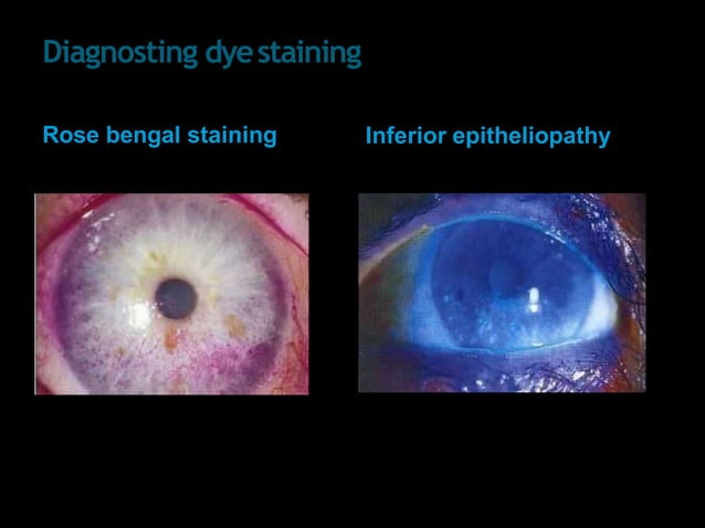 Dry eye diagnosis and management | PPTX