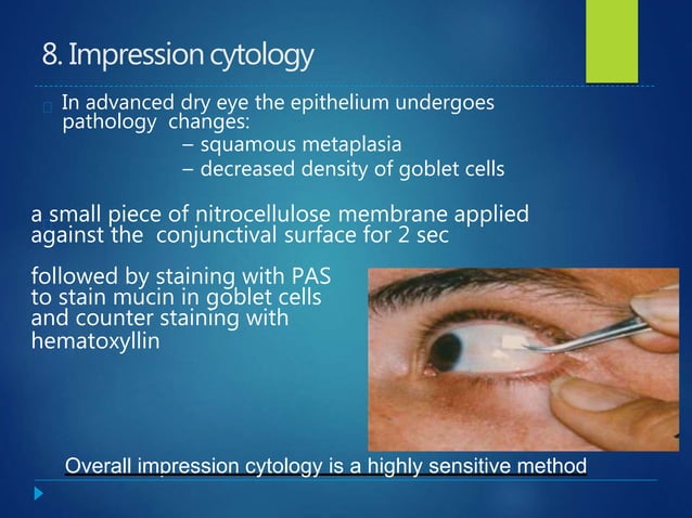 Dry eye diagnosis and management | PPTX